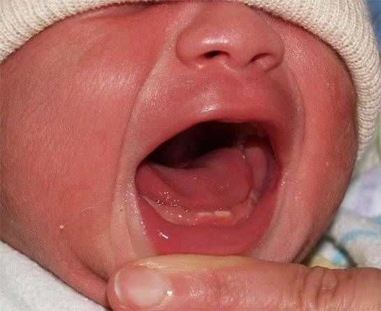 When Your Baby Arrives With Teeth: A Complete Guid... | Fishbowl