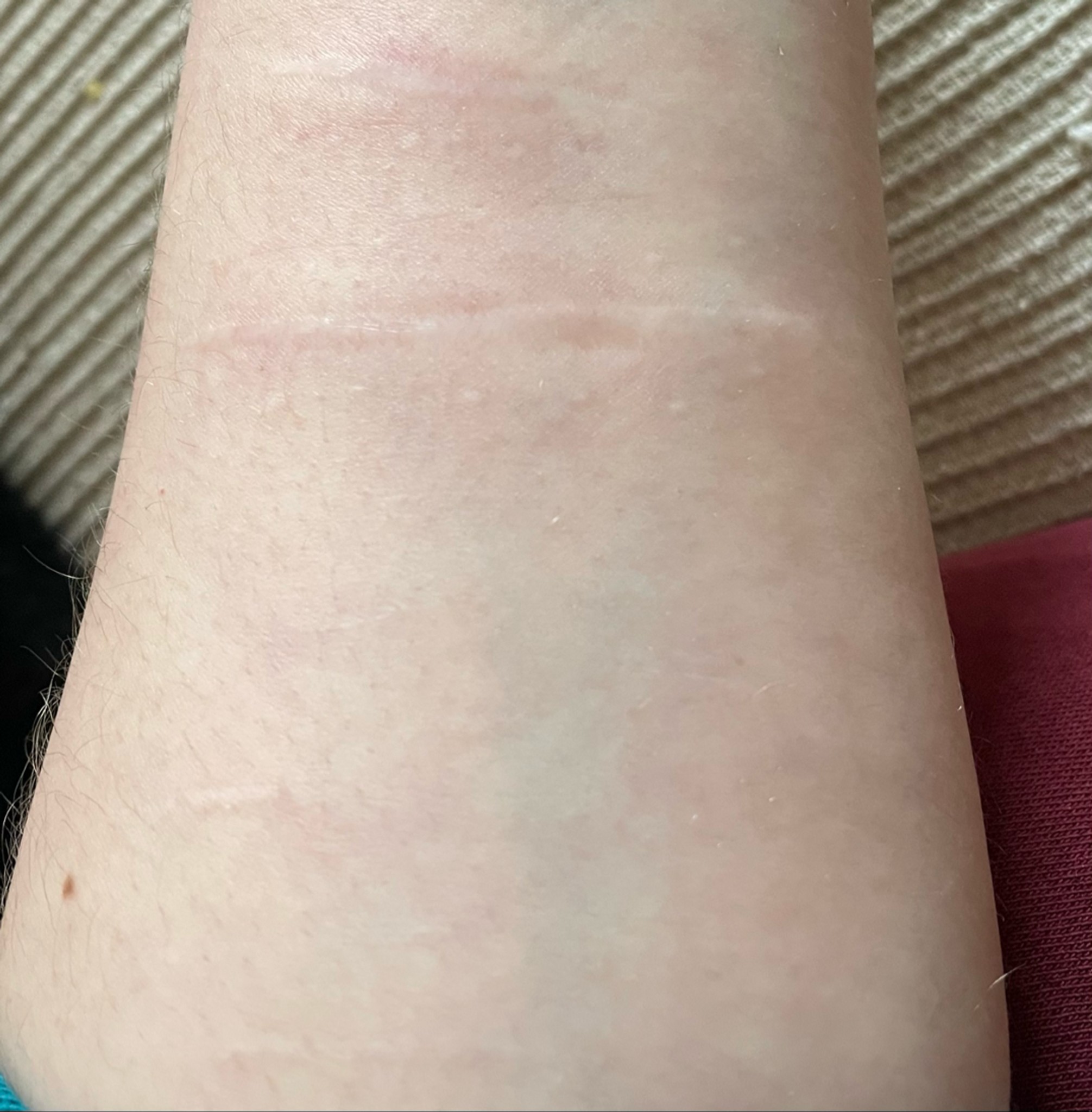 Thoughts on having scars from self harm visible while at the office ...